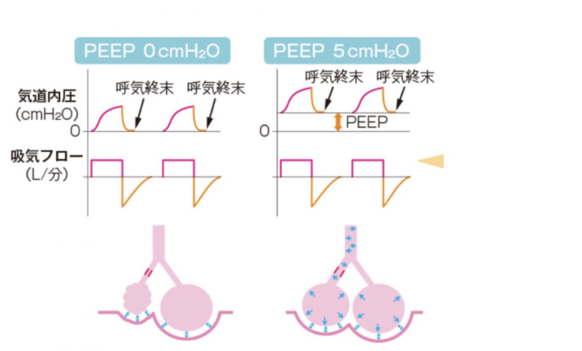 陽圧換気を行うバッグ – にしじまクリニックブログ